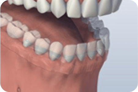 Implant Retained Dentures / Overdenture - PeakView Dentistry Boulder ...