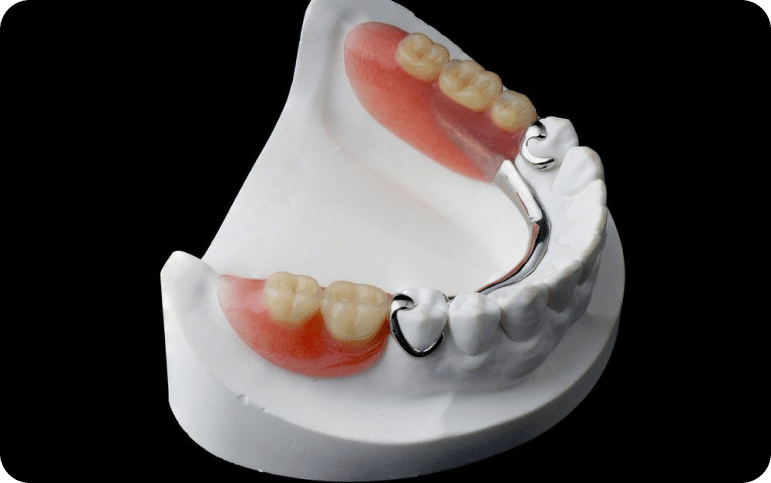 Partial Dentures for Back Teeth Boulder, CO | PeakView Dentistry ...