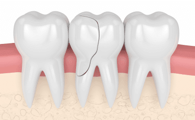 Types of Dental Root Fractures Boulder, CO | PeakView Dentistry | Root ...