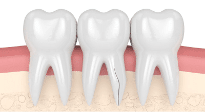 Types of Dental Root Fractures Boulder, CO | PeakView Dentistry | Root ...