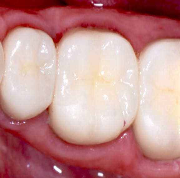 Composite Fillings Boulder, CO | PeakView Dentistry | All New Tooth ...