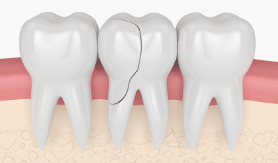 Types of Dental Root Fractures Boulder, CO | PeakView Dentistry | Root ...